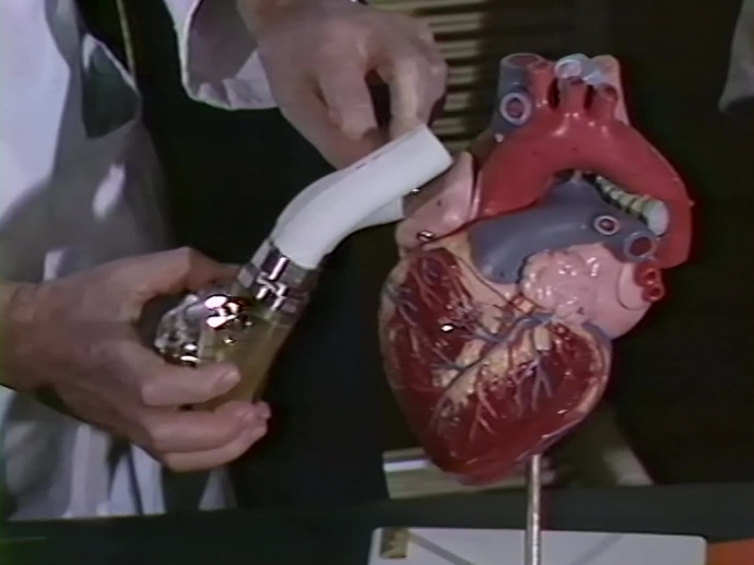 1ère pose en France coeur artificiel | INA